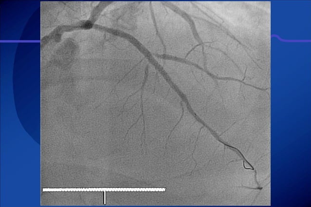 Part ecg stemi nstemi 2019 | PPT | Heart and Cardiovascular Diseases ...