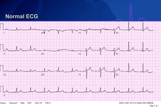 Part ecg stemi nstemi 2019 | PPT | Heart and Cardiovascular Diseases ...