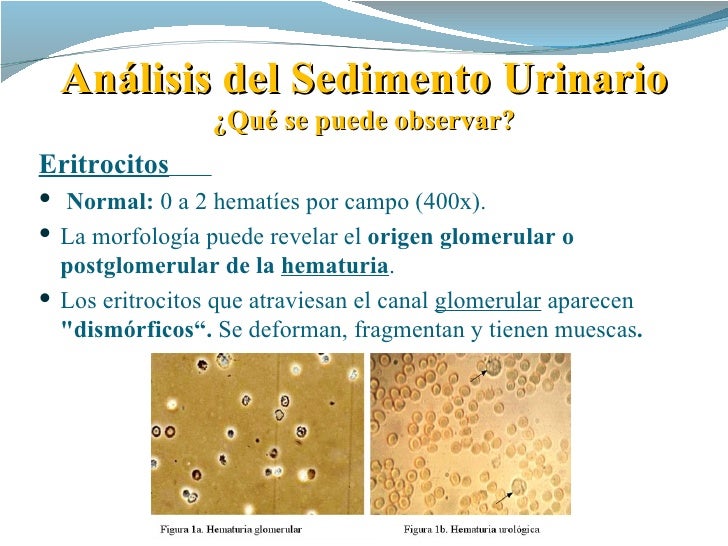 Sedimento Urinario Sedimento Urinario Valores Normales Phbfr