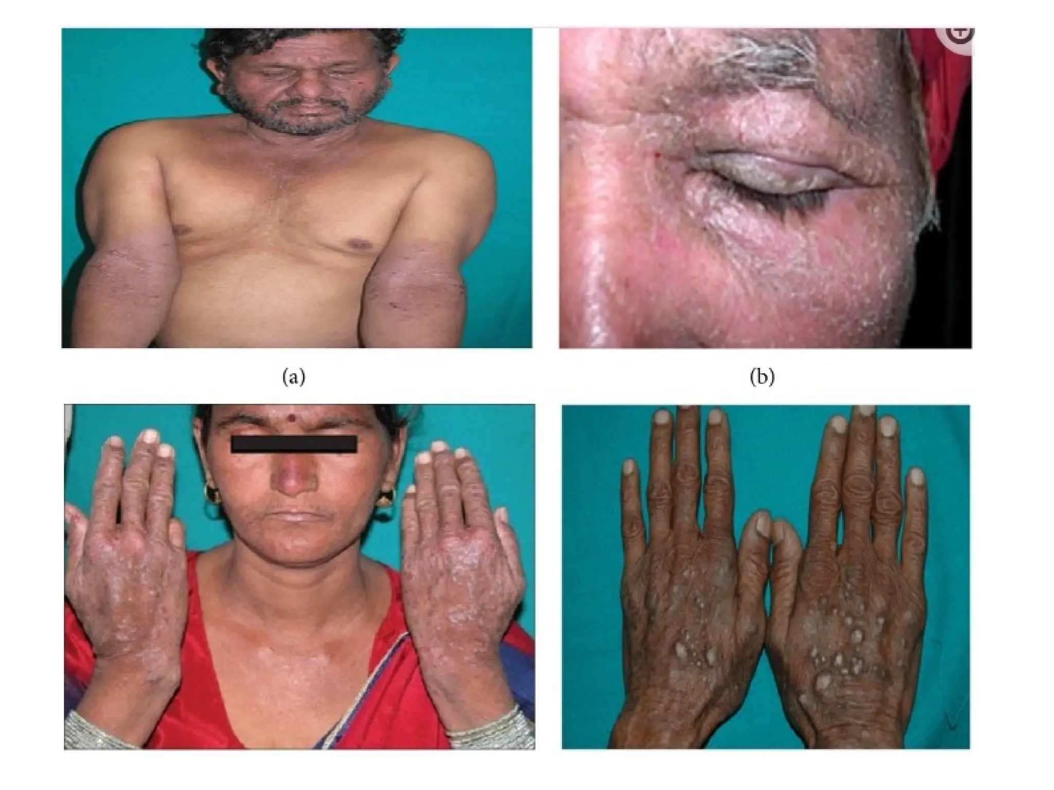 Parthenium Awarness Week-2024, Dr. JAGADISH | PPTX