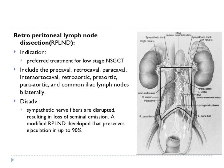 Part 1 management of testicular carcinoma - dr vandana