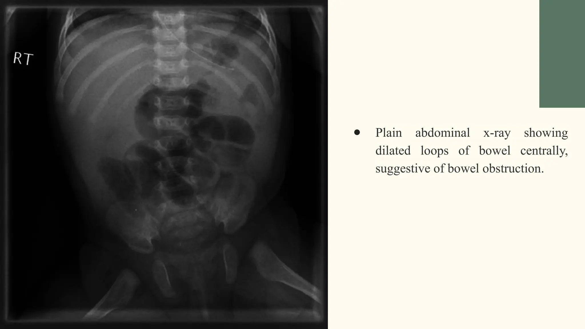 Partial-Intestinal-Obstruction-Secondary-to-Intussusception.pptx