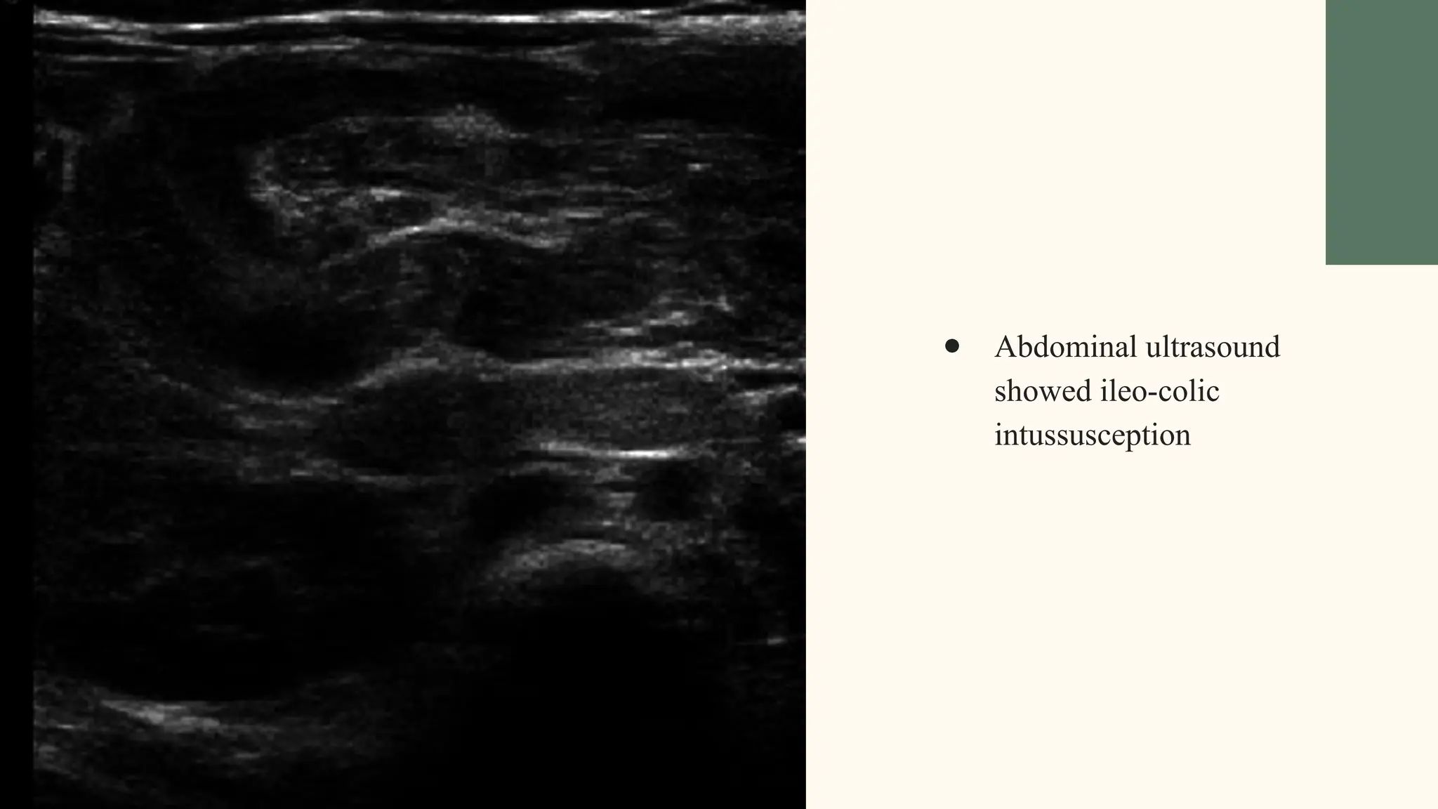 Partial-Intestinal-Obstruction-Secondary-to-Intussusception.pptx