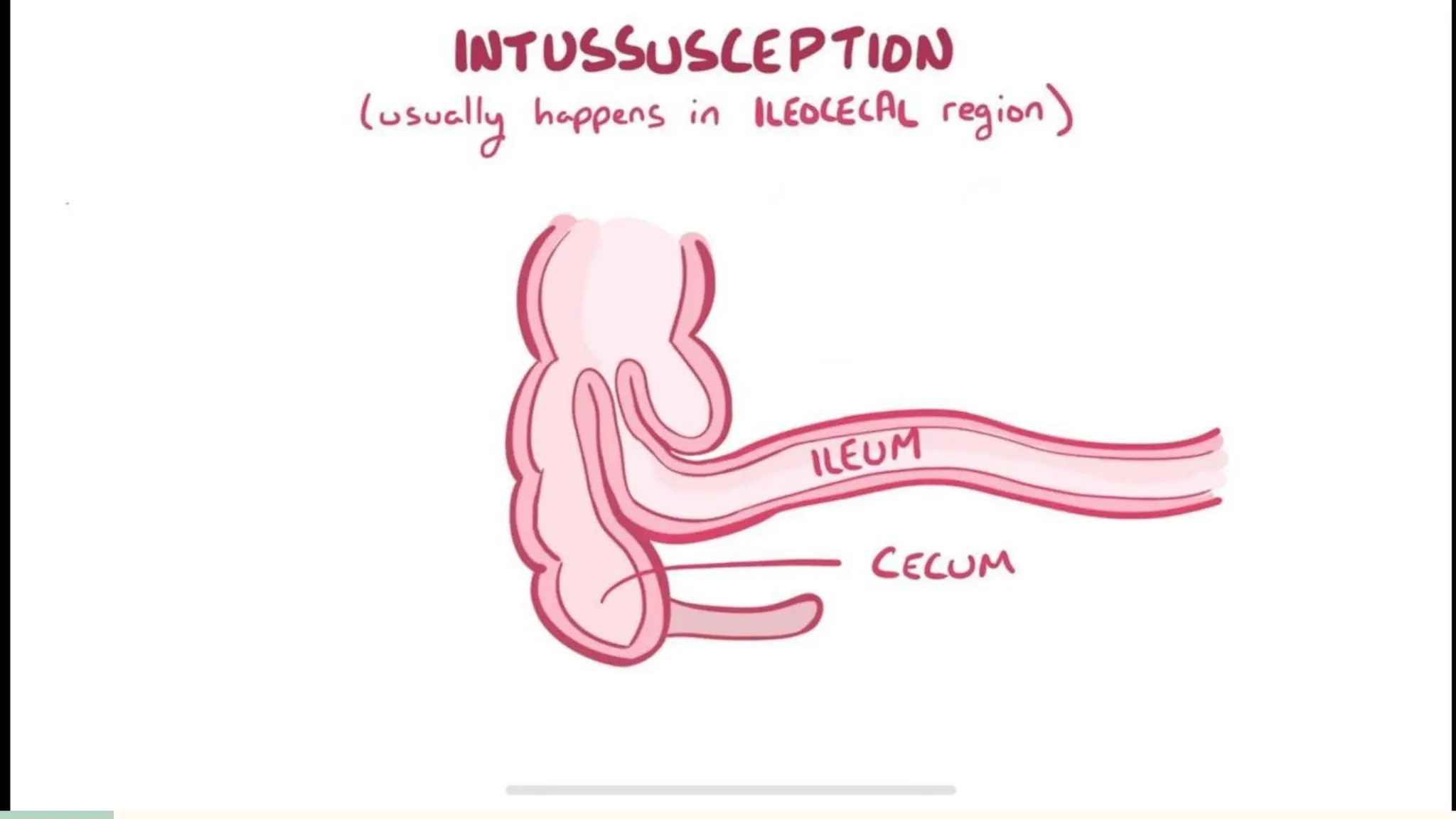 Partial-Intestinal-Obstruction-Secondary-to-Intussusception.pptx