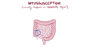 Partial-Intestinal-Obstruction-Secondary-to-Intussusception.pptx