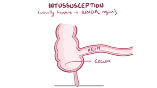 Partial-Intestinal-Obstruction-Secondary-to-Intussusception.pptx