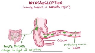 Partial-Intestinal-Obstruction-Secondary-to-Intussusception.pptx