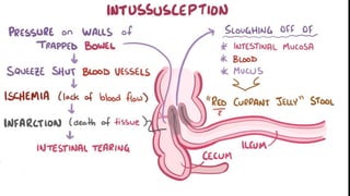Partial-Intestinal-Obstruction-Secondary-to-Intussusception.pptx
