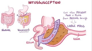 Partial-Intestinal-Obstruction-Secondary-to-Intussusception.pptx