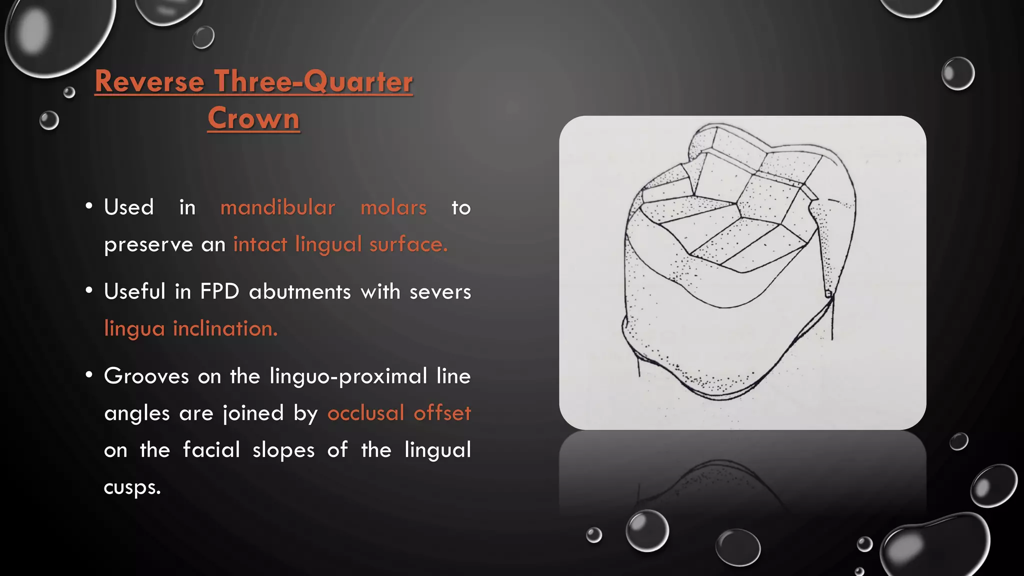 Partial Coverage Restorations.pdf