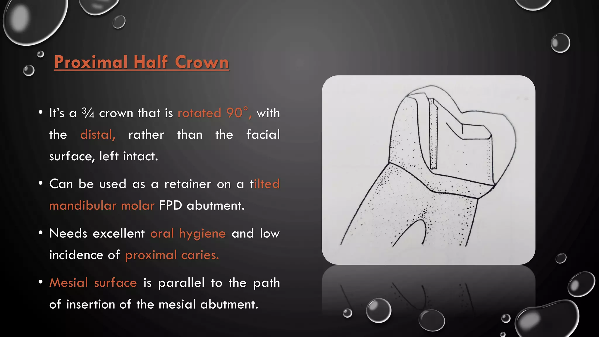 Partial Coverage Restorations.pdf