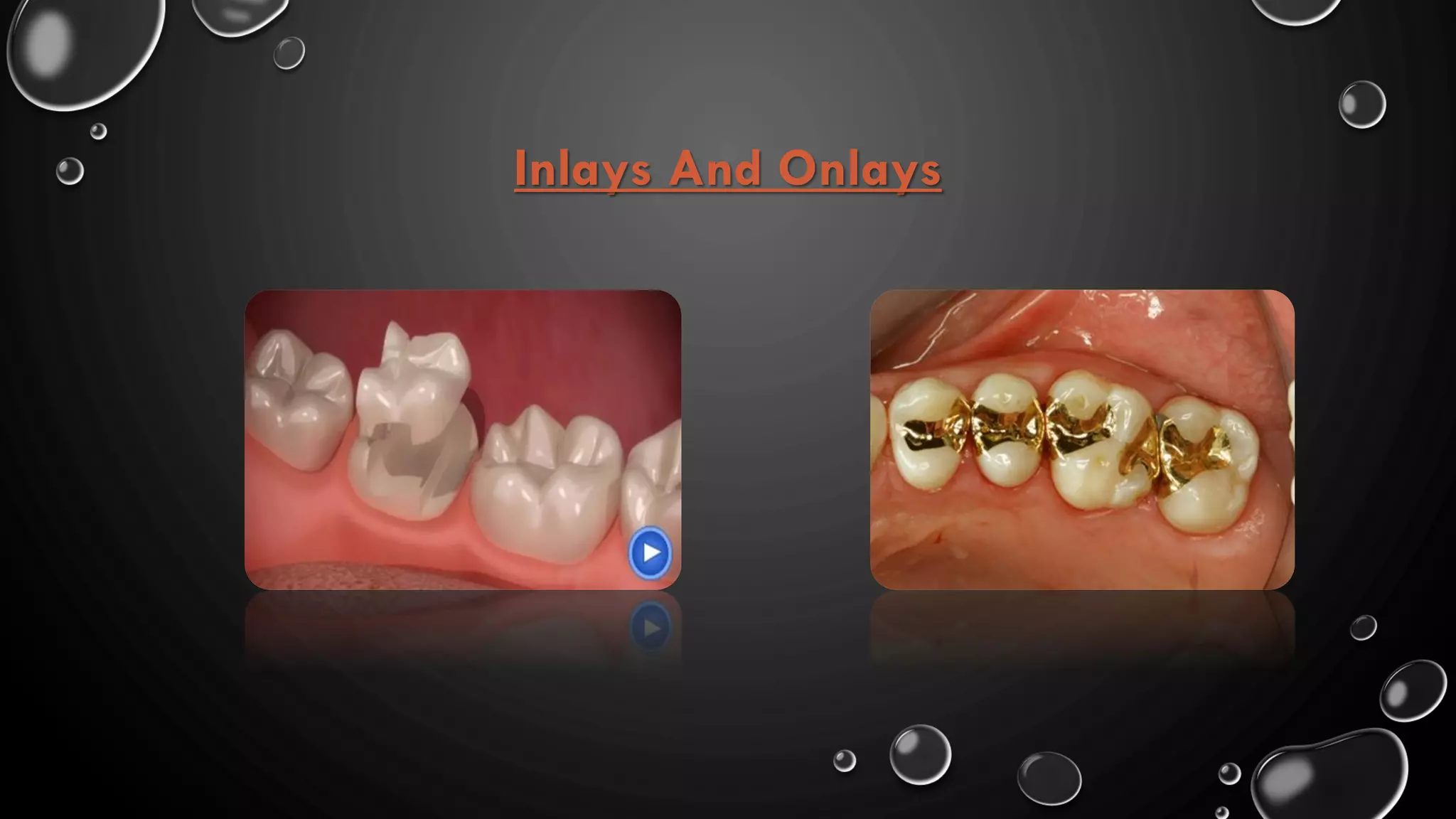 Partial Coverage Restorations.pdf