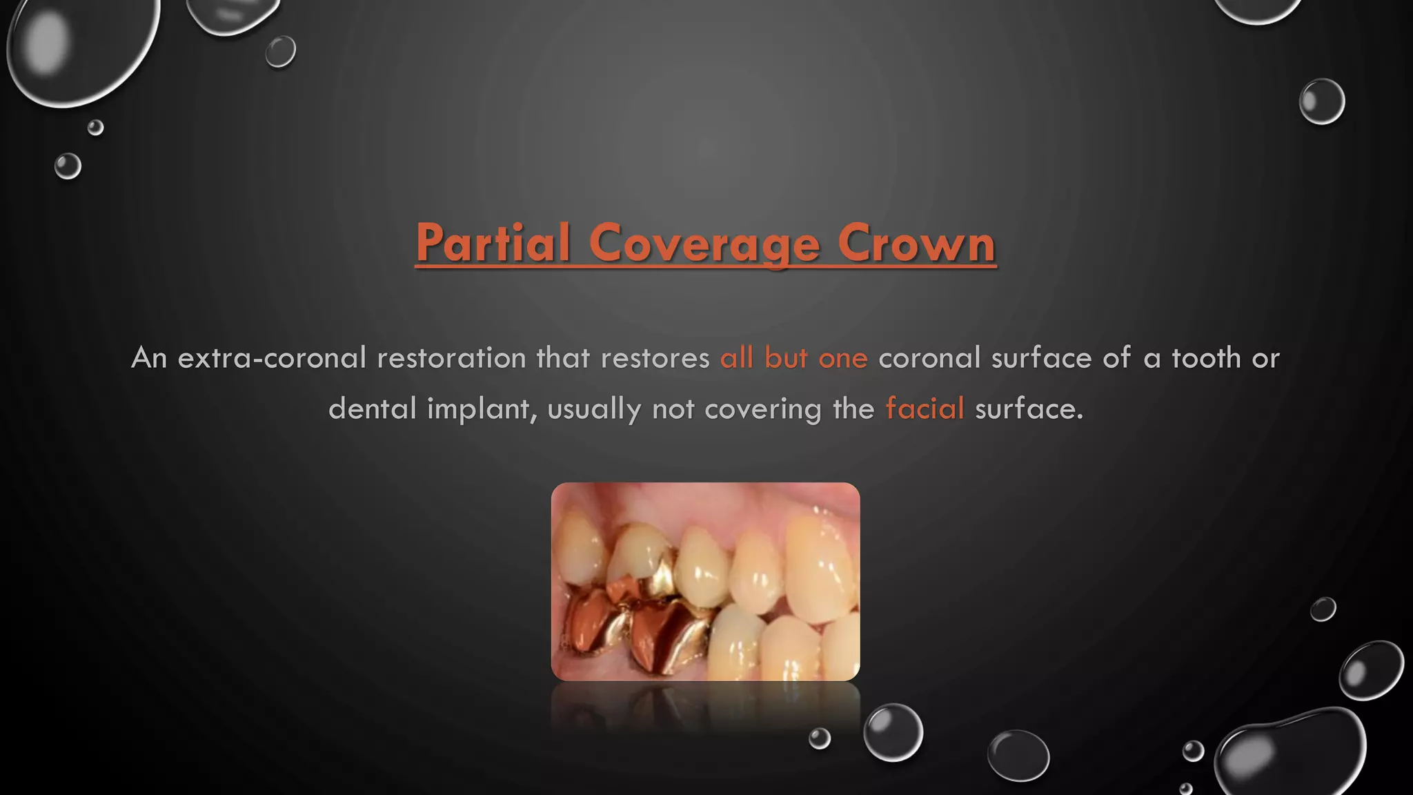 Partial Coverage Restorations.pdf