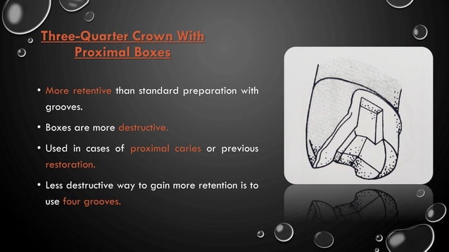 Partial Coverage Restorations.pdf