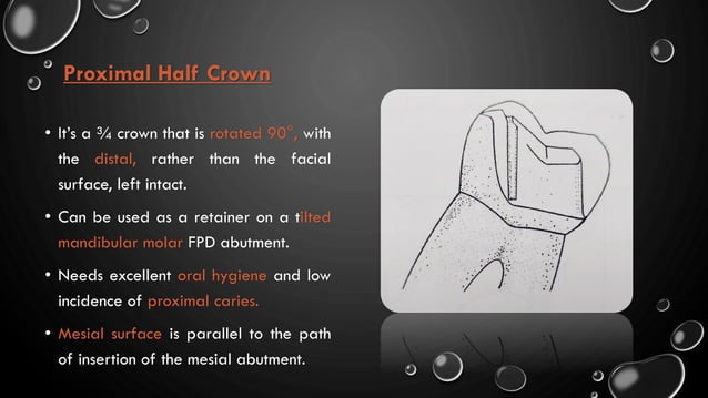 Partial Coverage Restorations.pdf