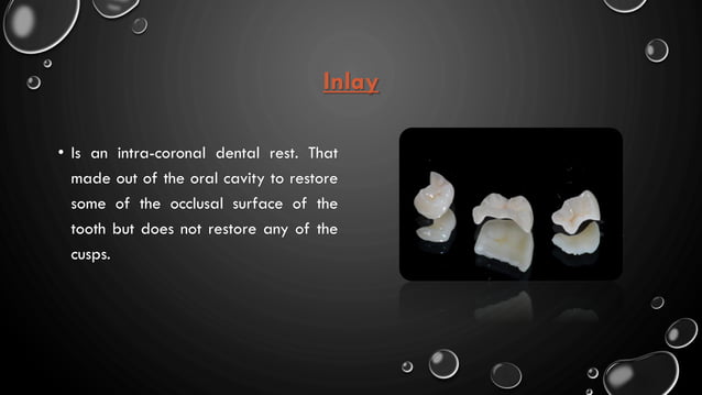Partial Coverage Restorations.pdf