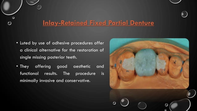 Partial Coverage Restorations.pdf