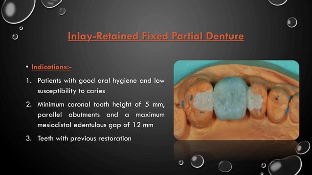 Partial Coverage Restorations.pdf