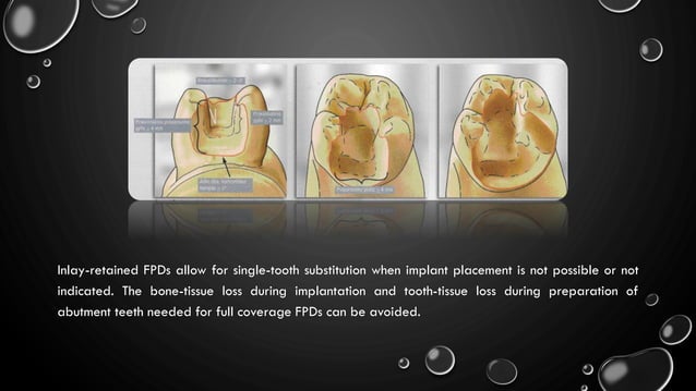 Partial Coverage Restorations.pdf