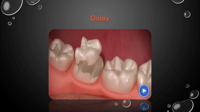 Partial Coverage Restorations.pdf