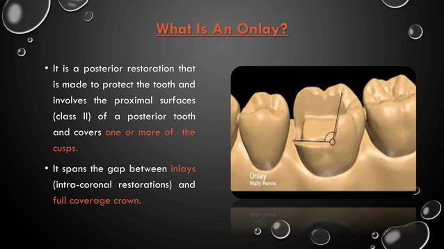Partial Coverage Restorations.pdf