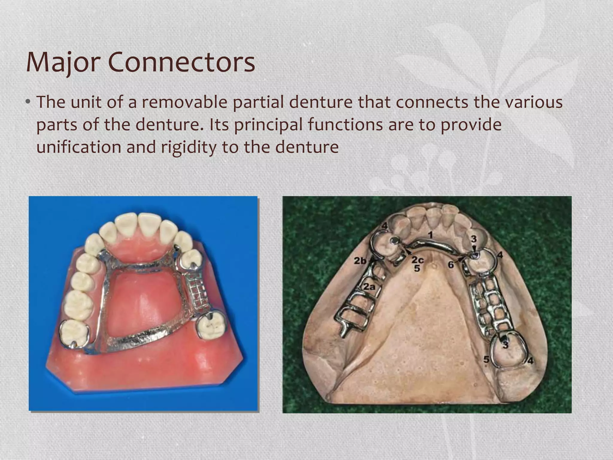 removable Partial denture | PPTX