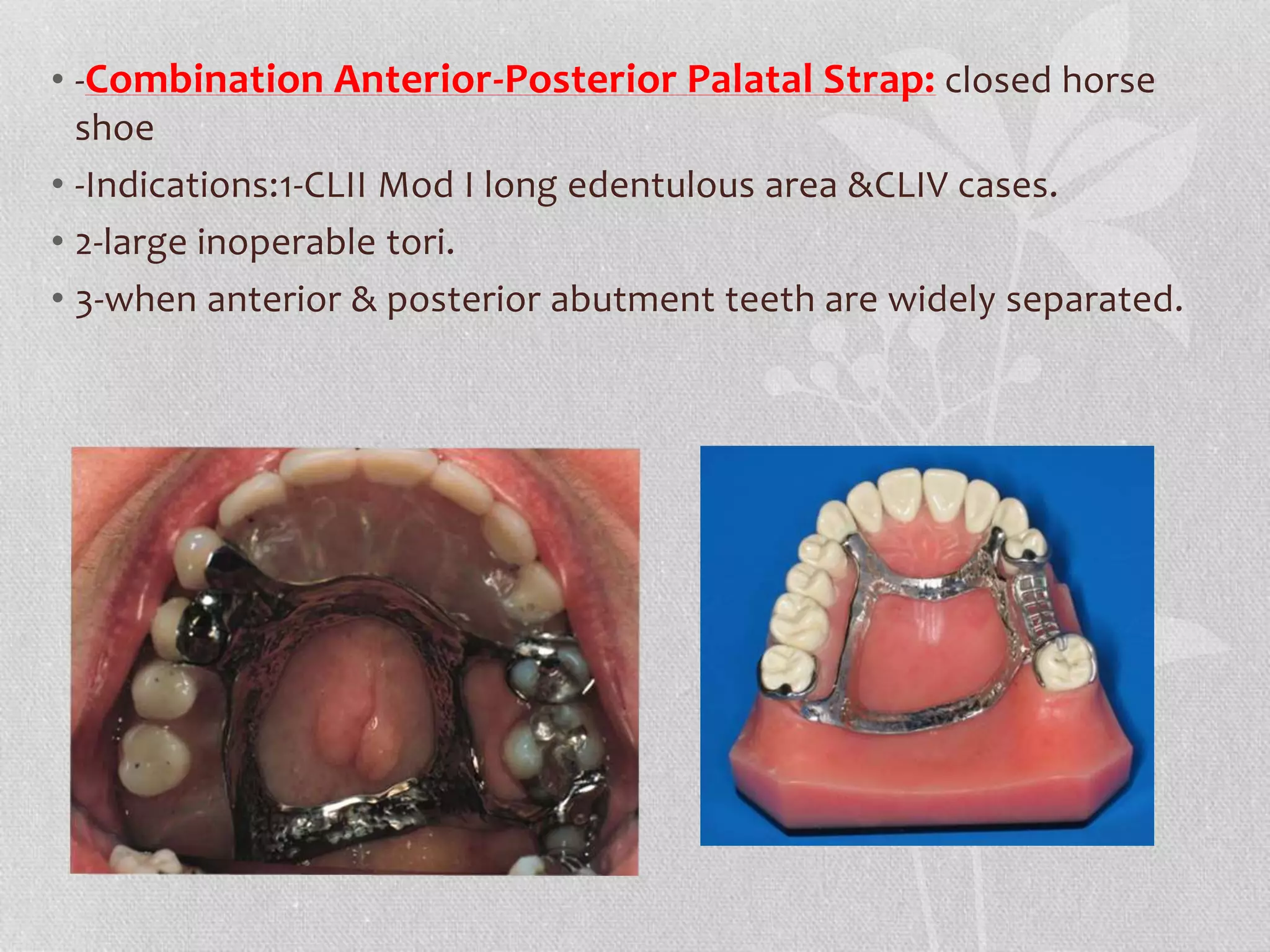 removable Partial denture | PPTX