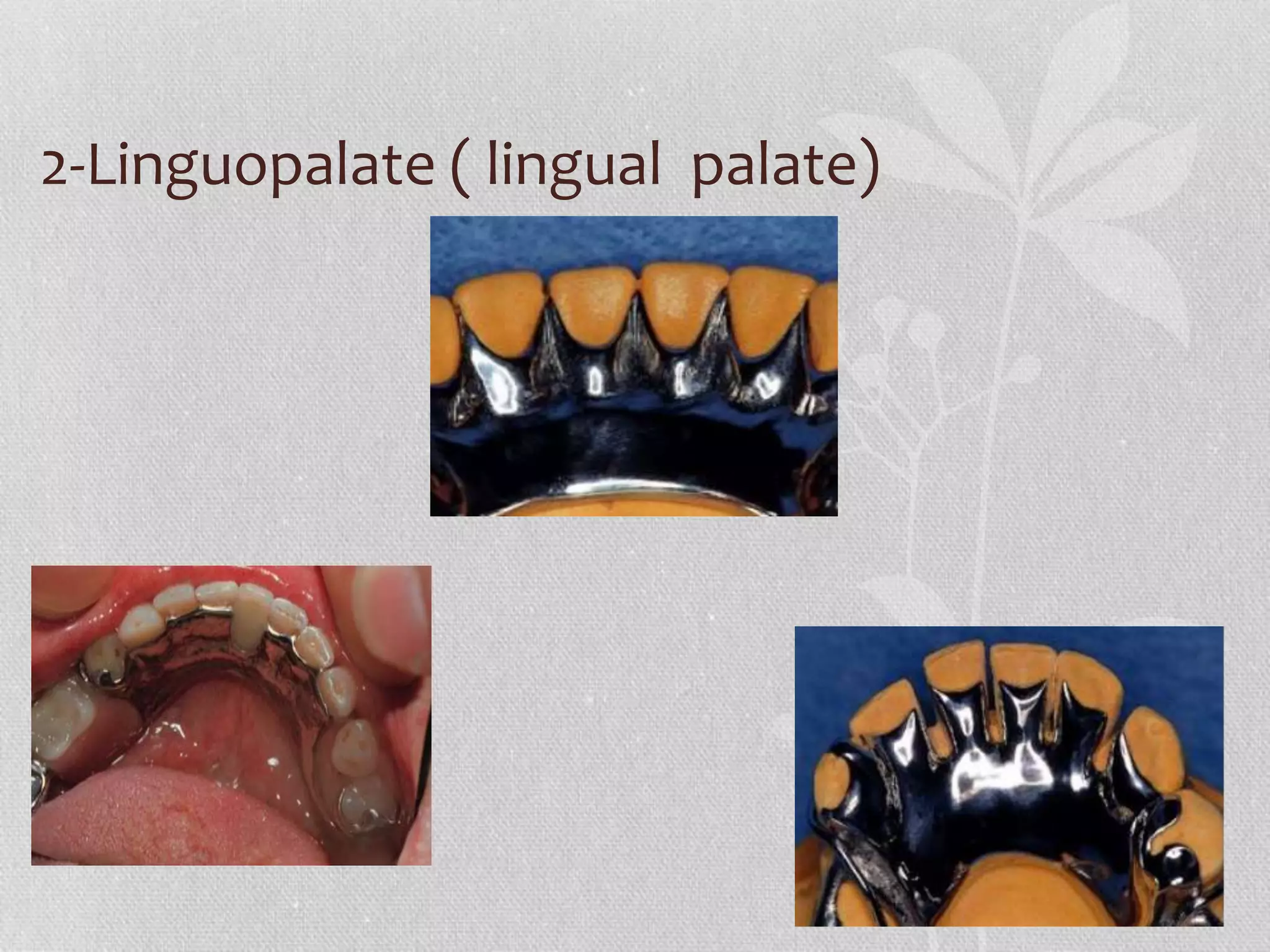 removable Partial denture | PPTX