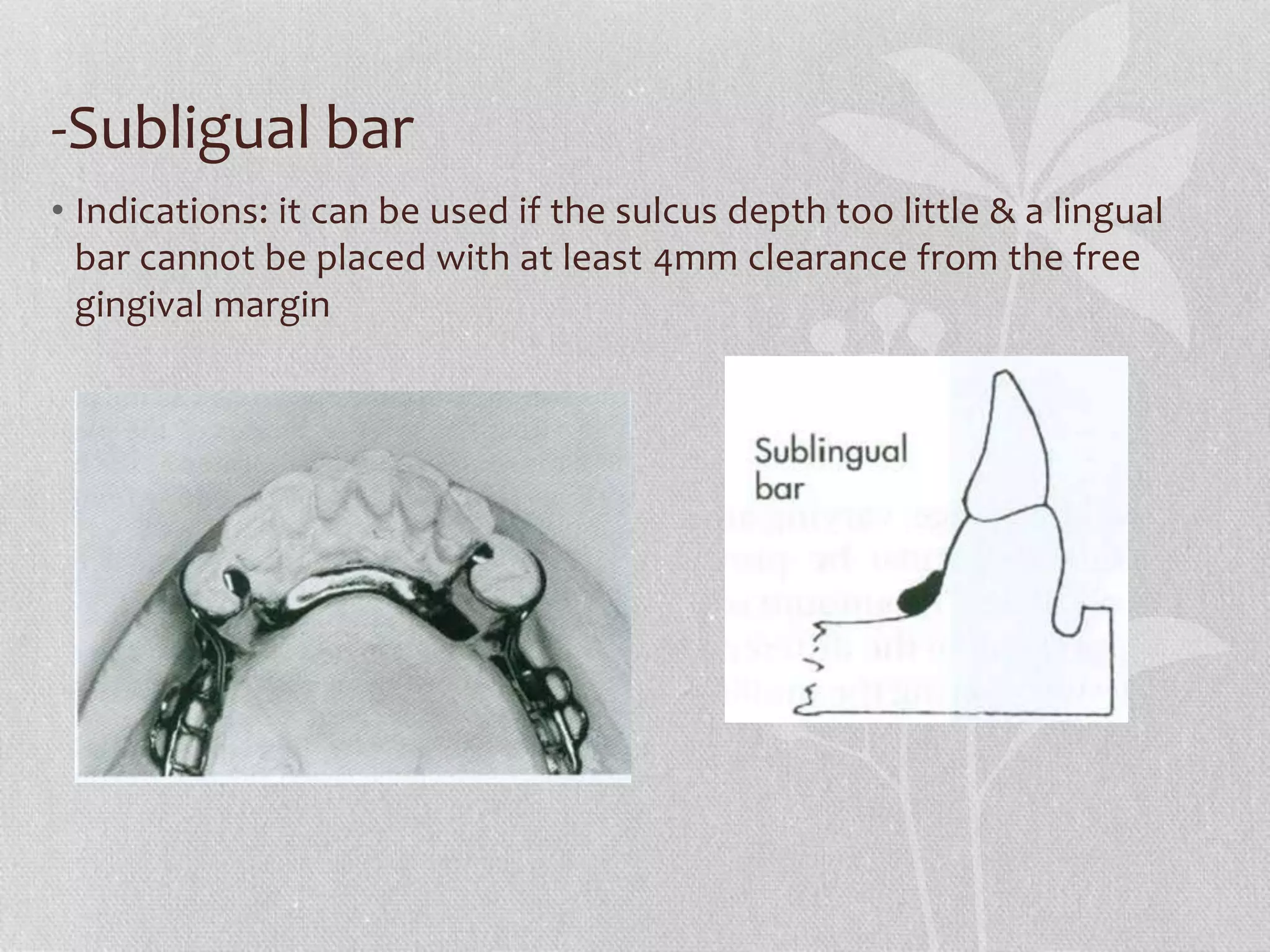removable Partial denture | PPTX