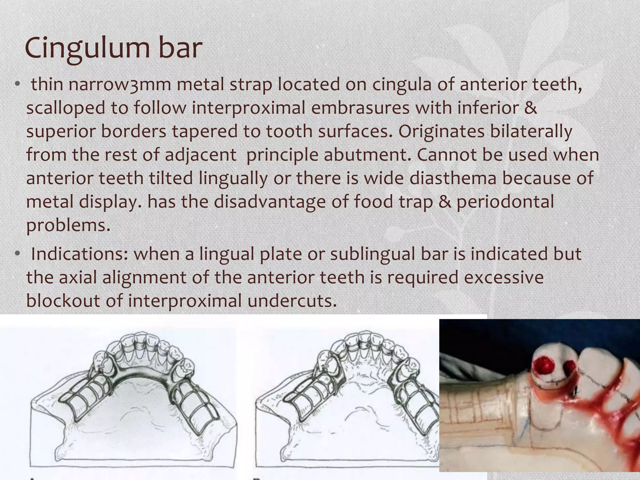 removable Partial denture | PPTX