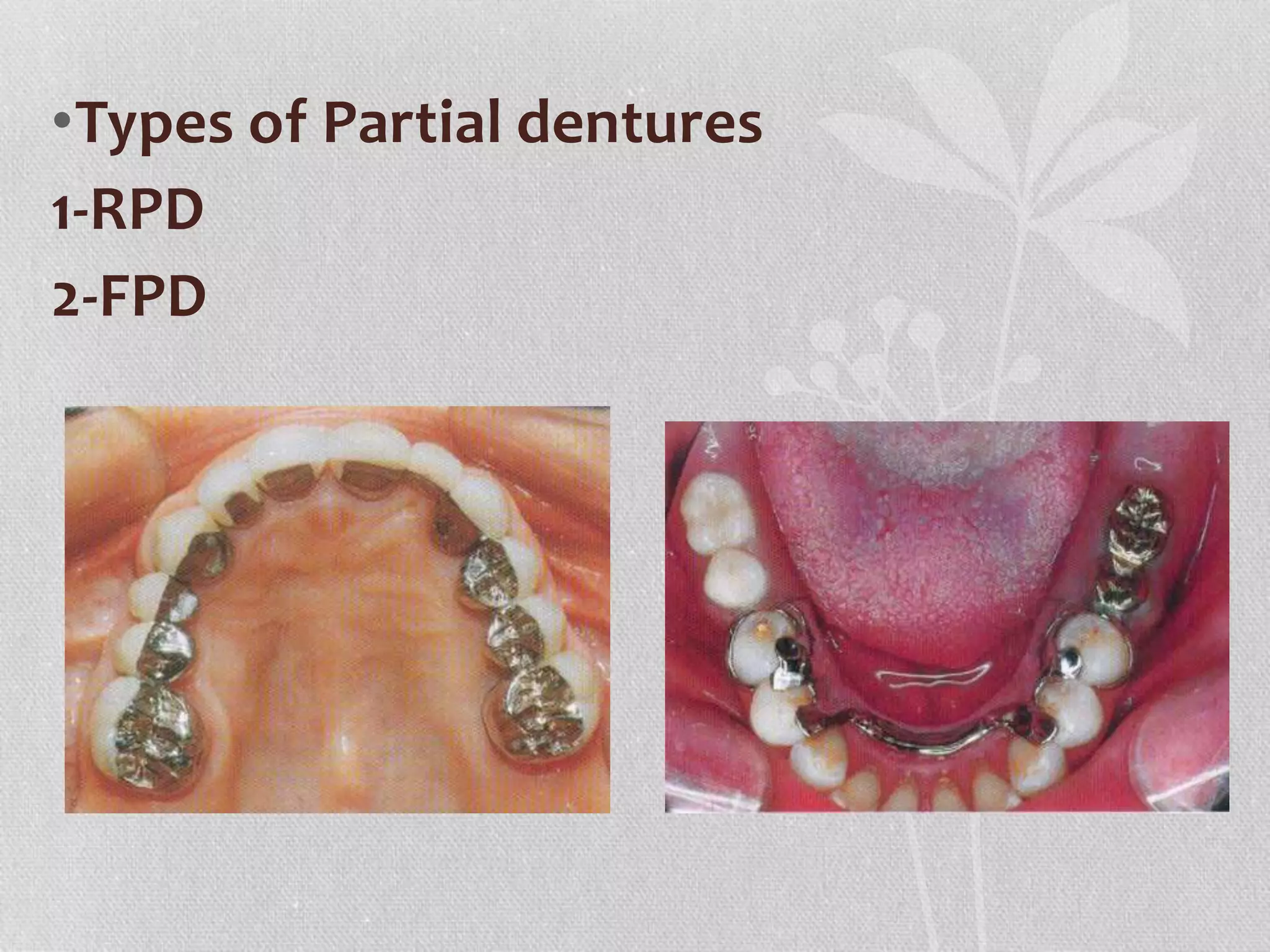 removable Partial denture | PPTX