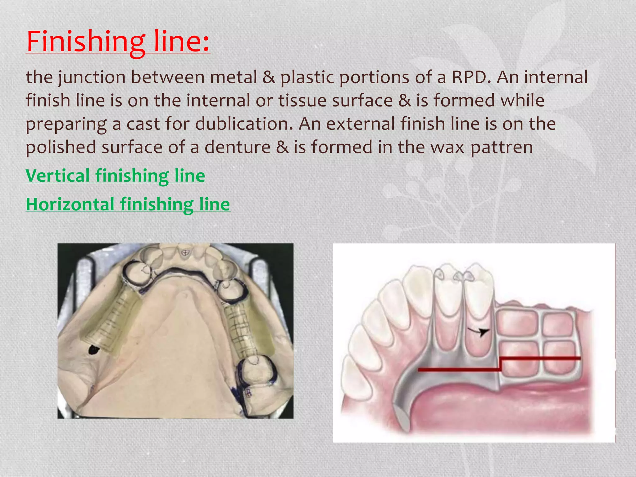 removable Partial denture | PPTX