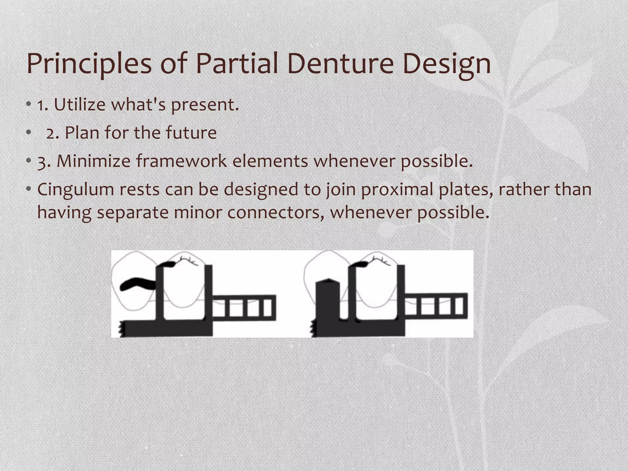 removable Partial denture | PPTX