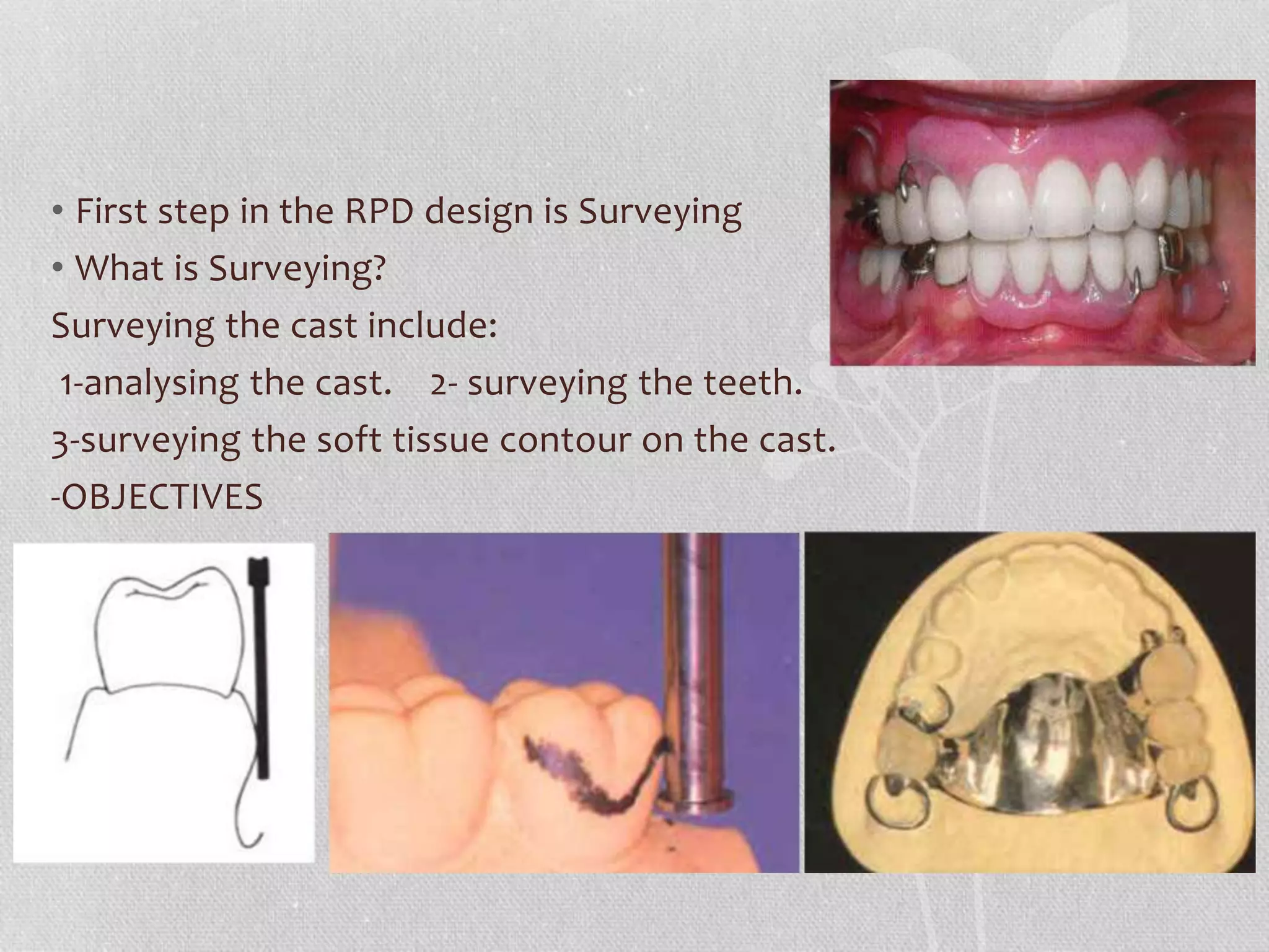 removable Partial denture | PPTX