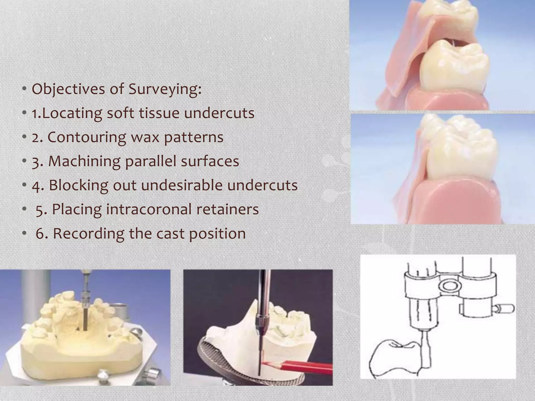 removable Partial denture | PPTX