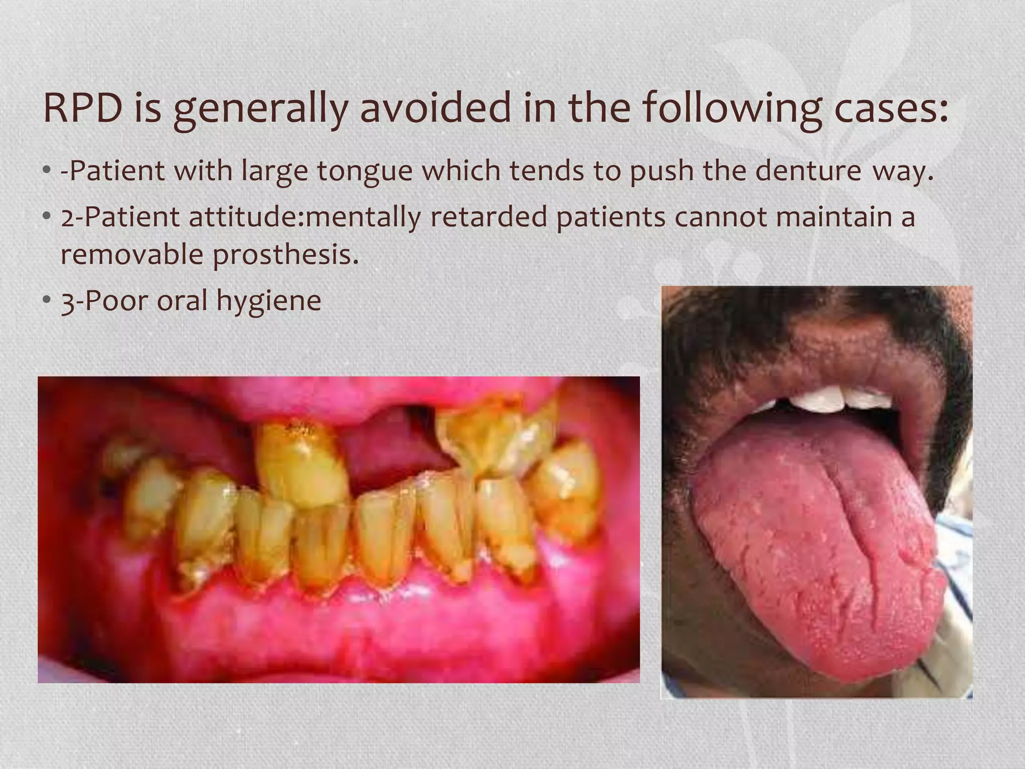 removable Partial denture | PPTX