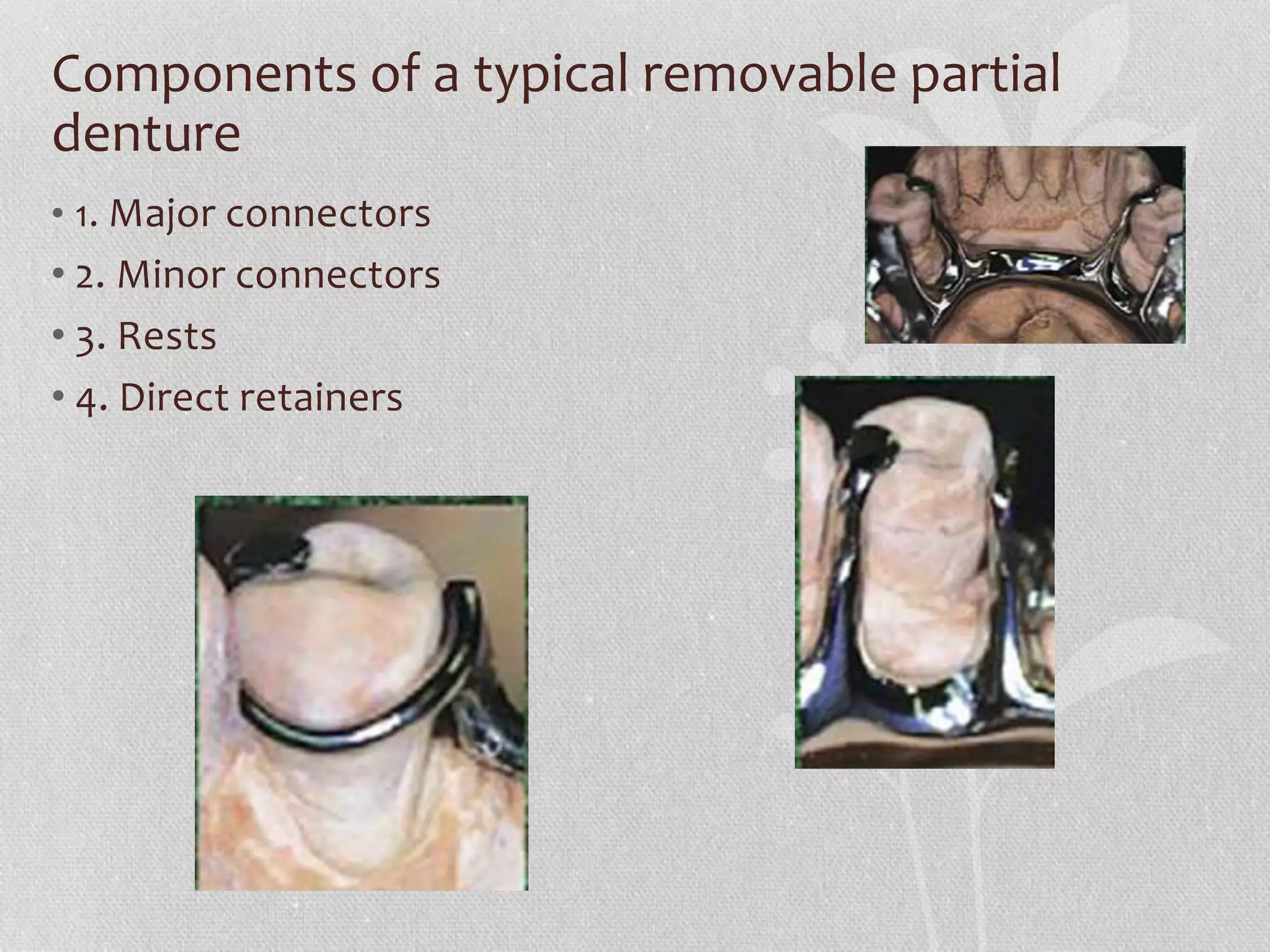 removable Partial denture | PPTX