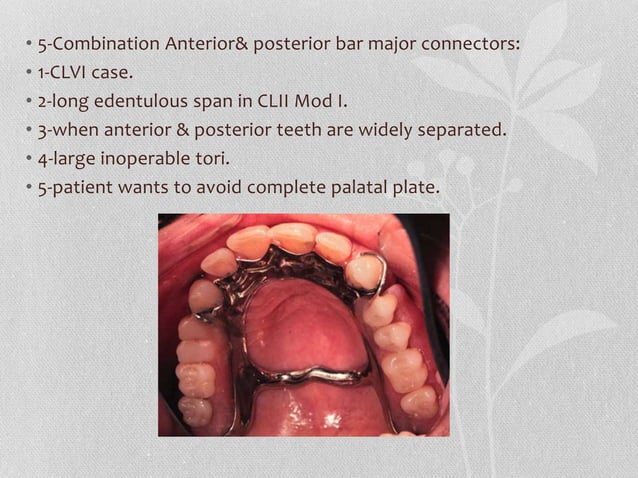 removable Partial denture | PPTX