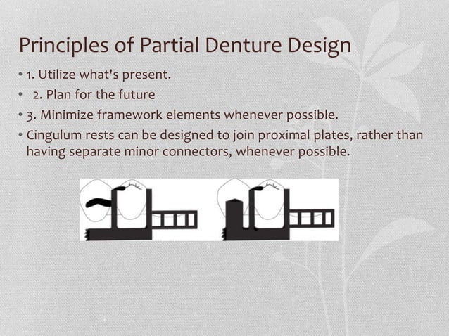 removable Partial denture | PPTX