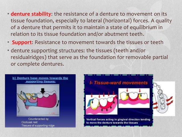 removable Partial denture | PPTX