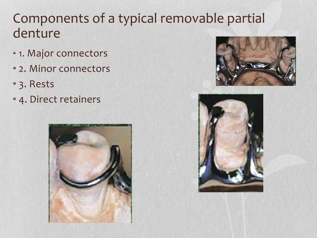 removable Partial denture | PPTX