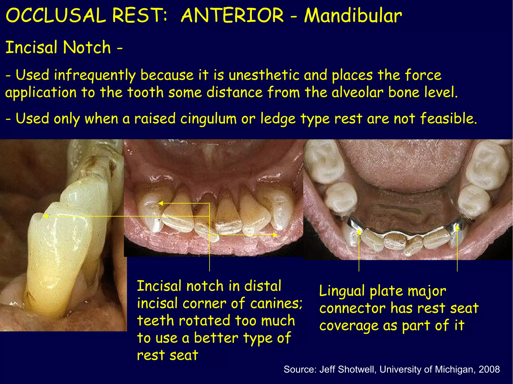Partial dentures | PPT