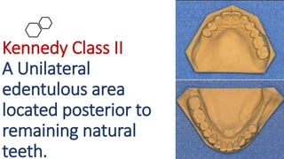 Partial Dentures.pptx