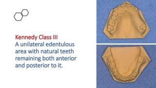 Partial Dentures.pptx