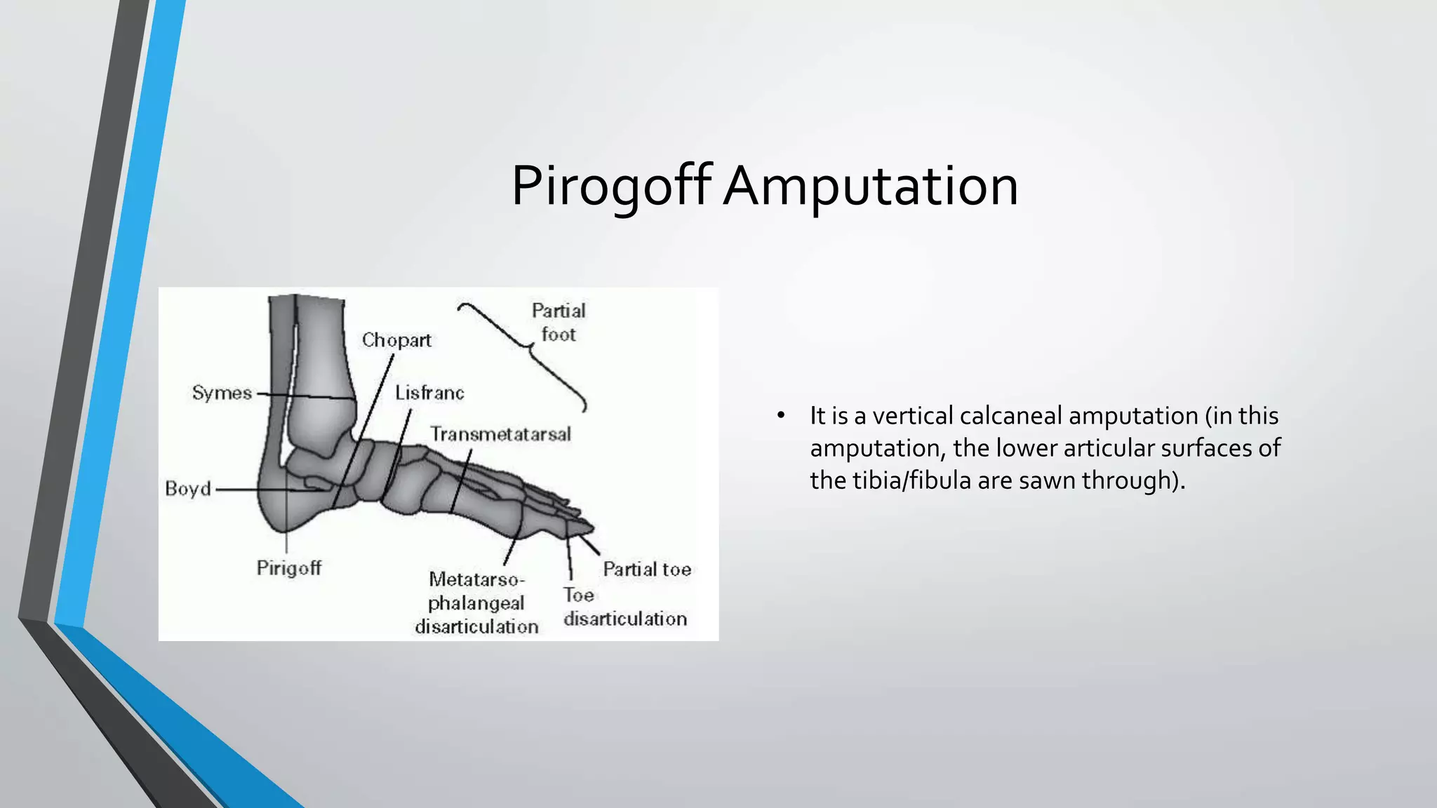 Prosthetic Management of Different Types of Partial Foot Amputation | PPTX