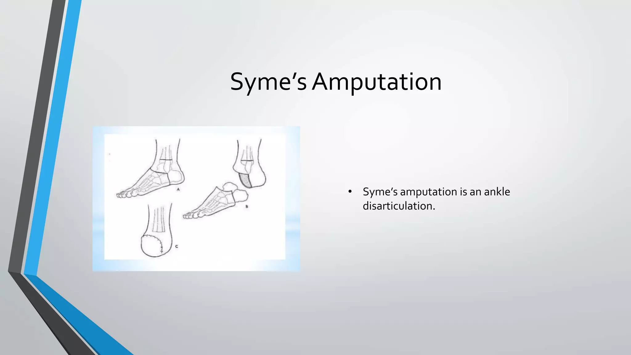 Prosthetic Management of Different Types of Partial Foot Amputation | PPTX