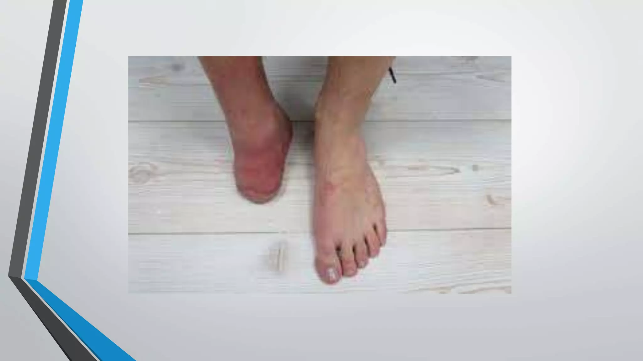 Prosthetic Management of Different Types of Partial Foot Amputation | PPTX