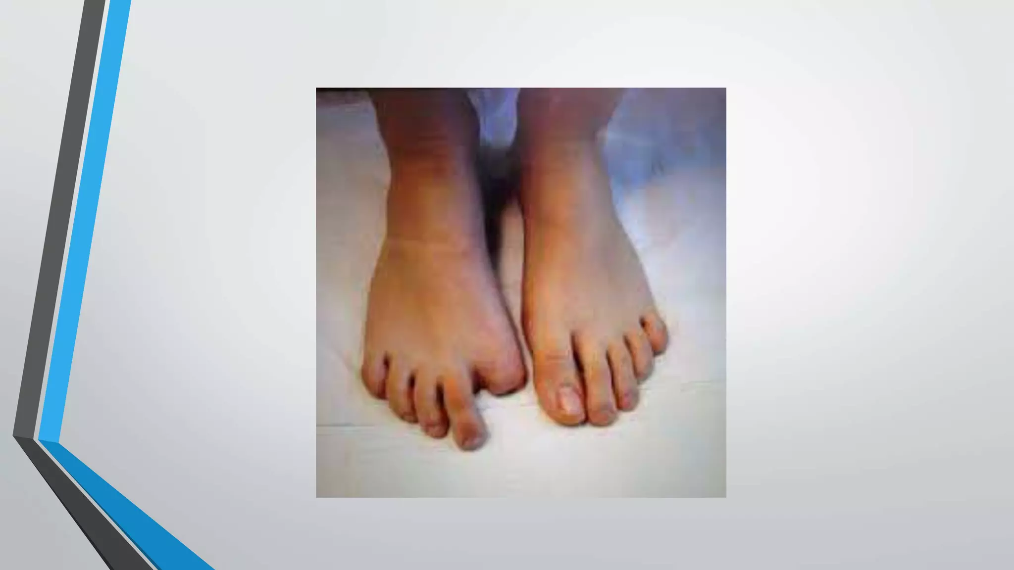 Prosthetic Management of Different Types of Partial Foot Amputation | PPTX