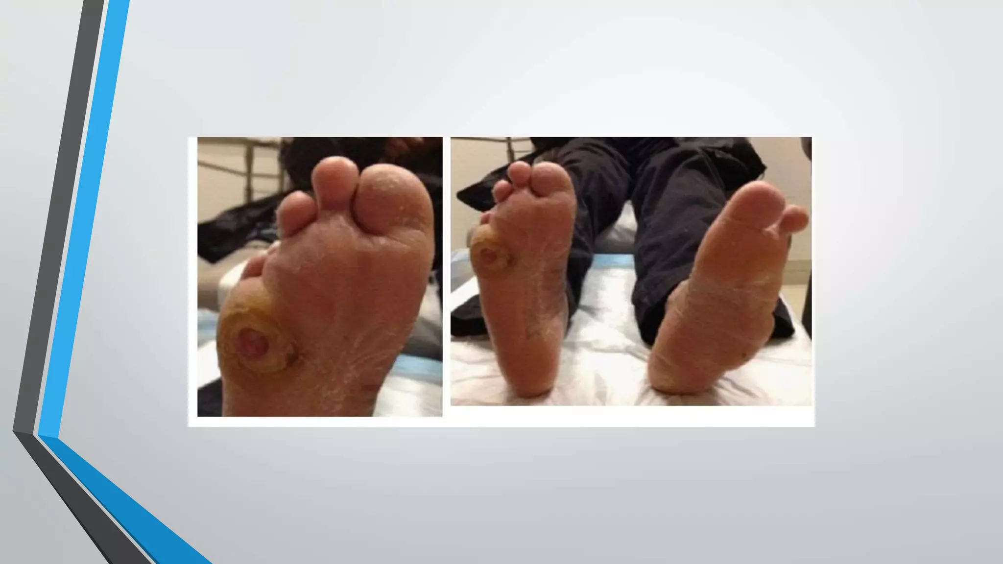 Prosthetic Management of Different Types of Partial Foot Amputation | PPTX