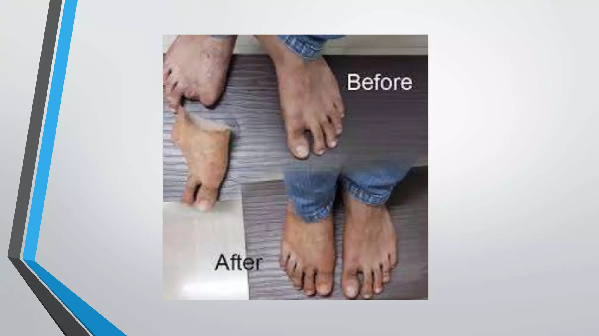 Prosthetic Management of Different Types of Partial Foot Amputation | PPTX